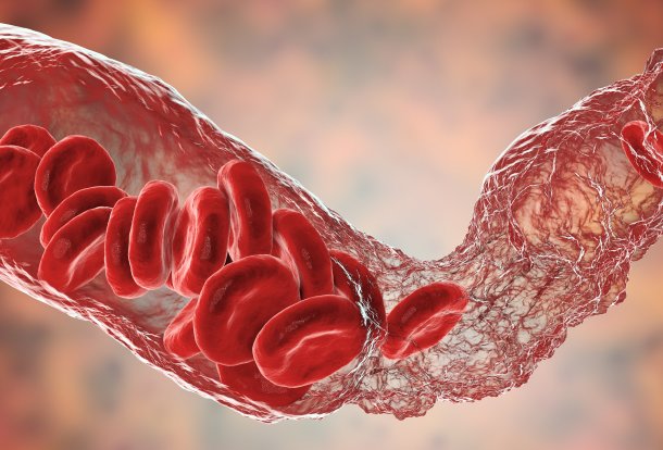Quels sont les signes d'une phlébite ? | La Mutuelle Générale